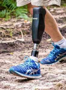 Анжела Макеева, пользователь бионической кисти VINCENTevolution4 - Endolite