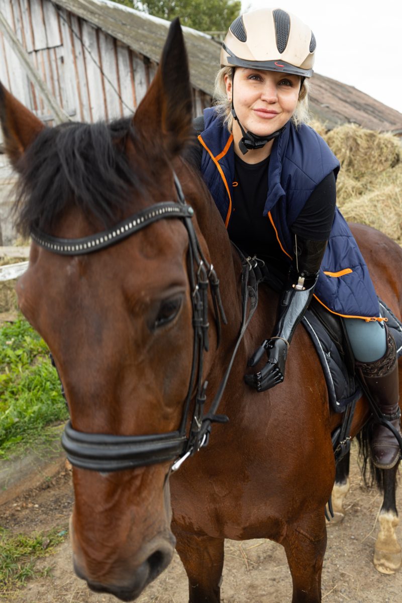 История Веры Шатиловой с бионической кистью Vincent Systems - Endolite