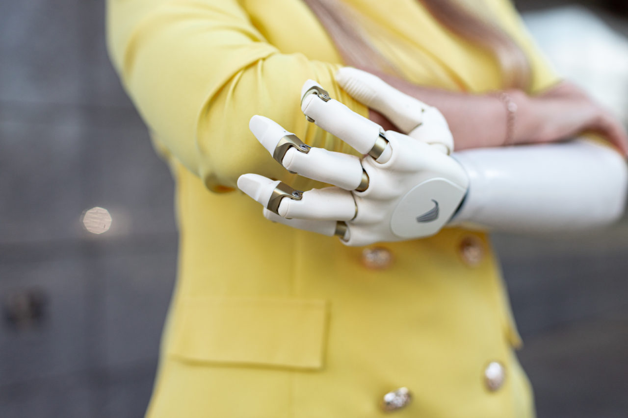 Анжела Макеева, пользователь бионической кисти VINCENTevolution4 - Endolite